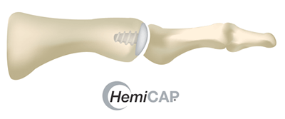 MTP Joint Replacement Surgery | Peter Rosenfeld FRCS, London